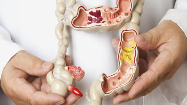 Rectal Prolapse: Causes, Symptoms, Treatments And More